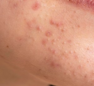 Facial Acne Skin - SR12 SKINCARE CLINIC